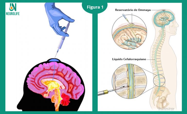 Quimioterapia Intratecal - Neurolife Análise do Líquor