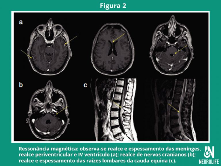 Quimioterapia Intratecal - Neurolife Análise do Líquor